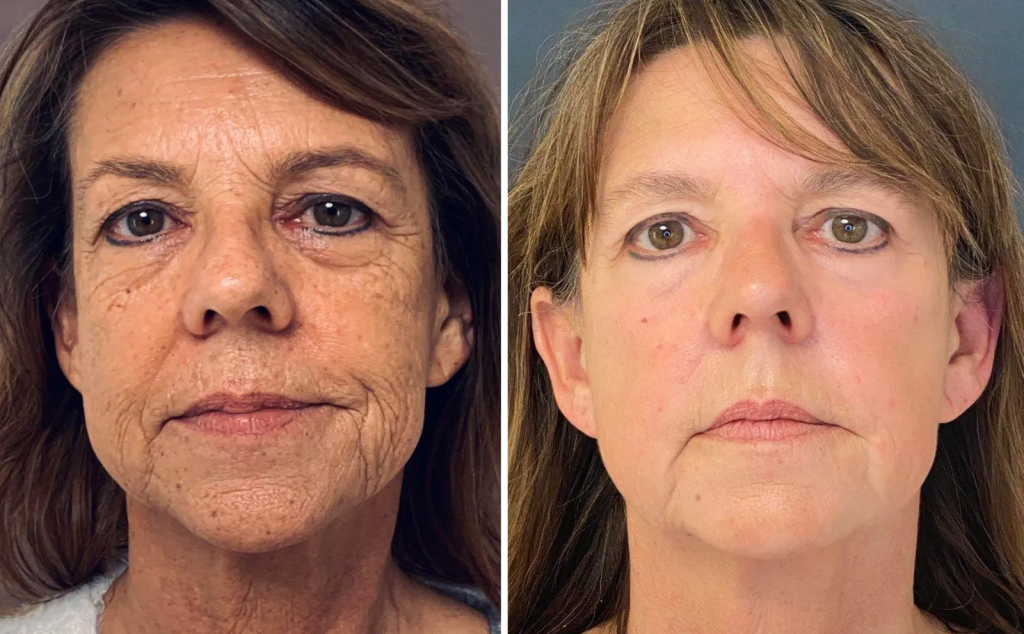 Peeling De Fenol Dá O Que Falar Entenda Se Vale A Pena